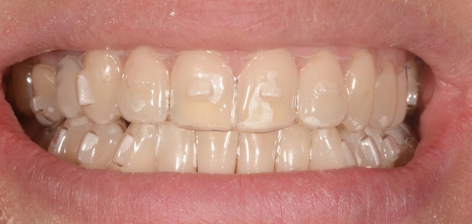 Ce Este Tratamentul Ortodontic Spark Clear Aligner Ce Este Tratamentul Ortodontic Spark Clear Aligner
